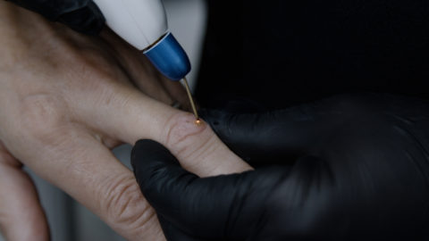 Verrues - Centre Laser et Esthétique Le Phenix